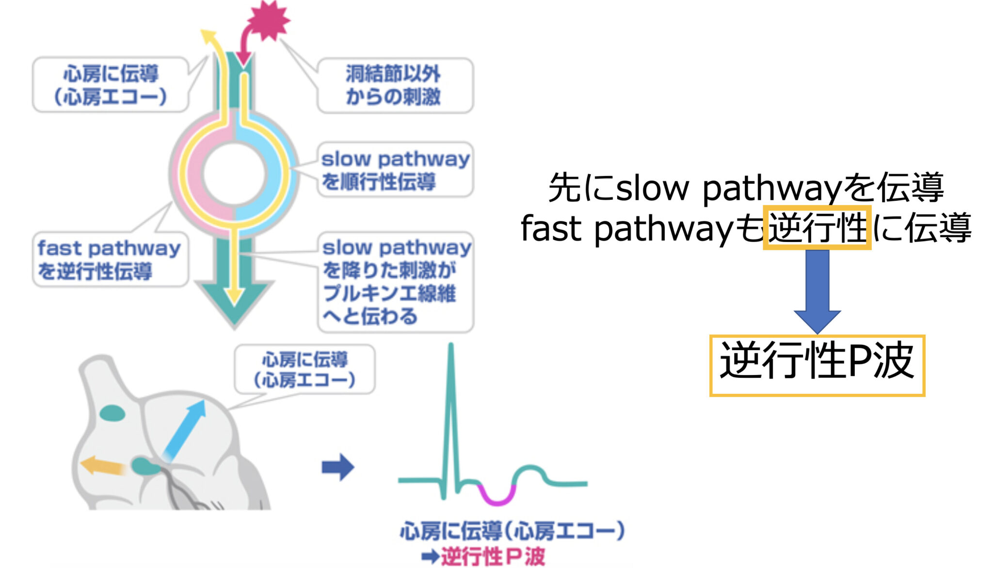 上室性不整脈の見分け方と対応