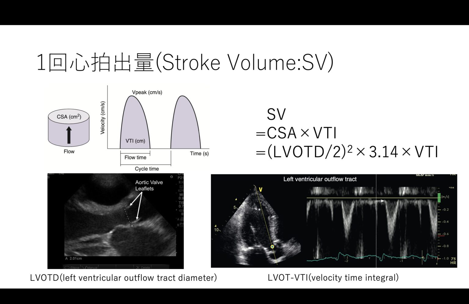 Vti エコー 測り方 | Lvotとは 心エコー | 心エコー：LVOT径の測り方 – SBECQ